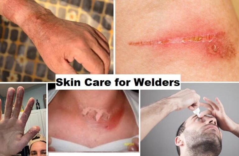 Skin Care for Welders | Welding of Welders